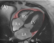 Publication: The value of fat tissue of the heart: comparing imaging ...